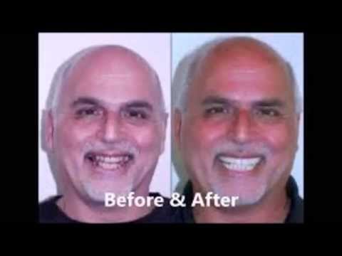 San Diego California Dental Implants – San Diego Ca Dental Implants!
