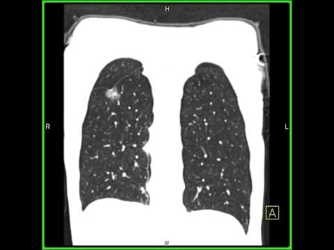 Lung Anatomy: Bronchoalveolar Cell Carcinoma (2 of 3)