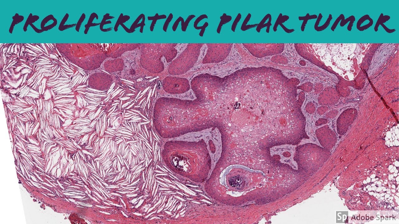 Proliferating Pilar Tumor: 5-Minute Pathology Pearls