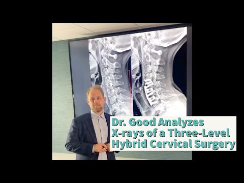 Dr. Good Analyzes X-rays of a Three-Level Hybrid Cervical Surgery