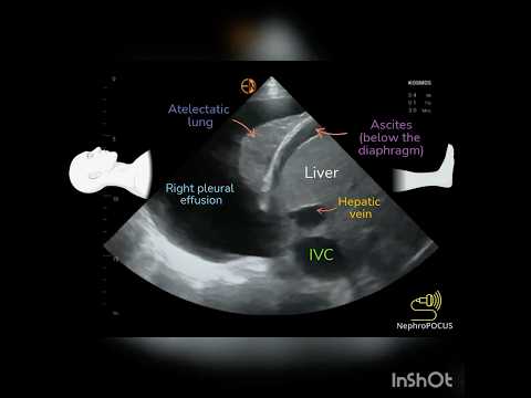 Pleural effusion on Ultrasound (POCUS) #pleuraleffusion