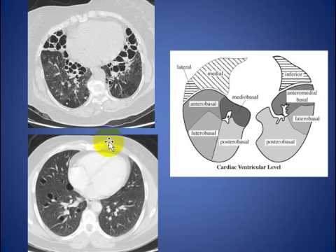 Radiology Rounds 06 Normal CT segmental Lung Anatomy