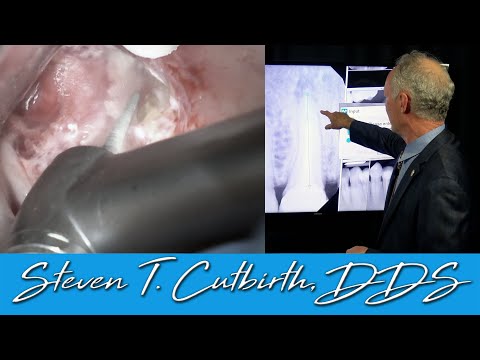 Apicoectomy on an Endo Tooth - Dental Minute with Steven T. Cutbirth, DDS