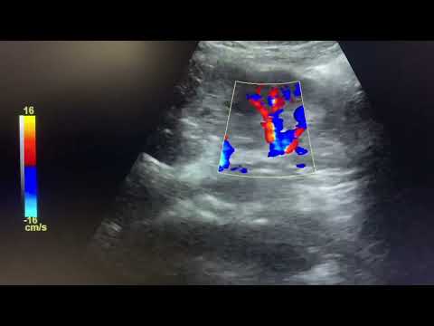 Cross fused renal ectopia ultrasound