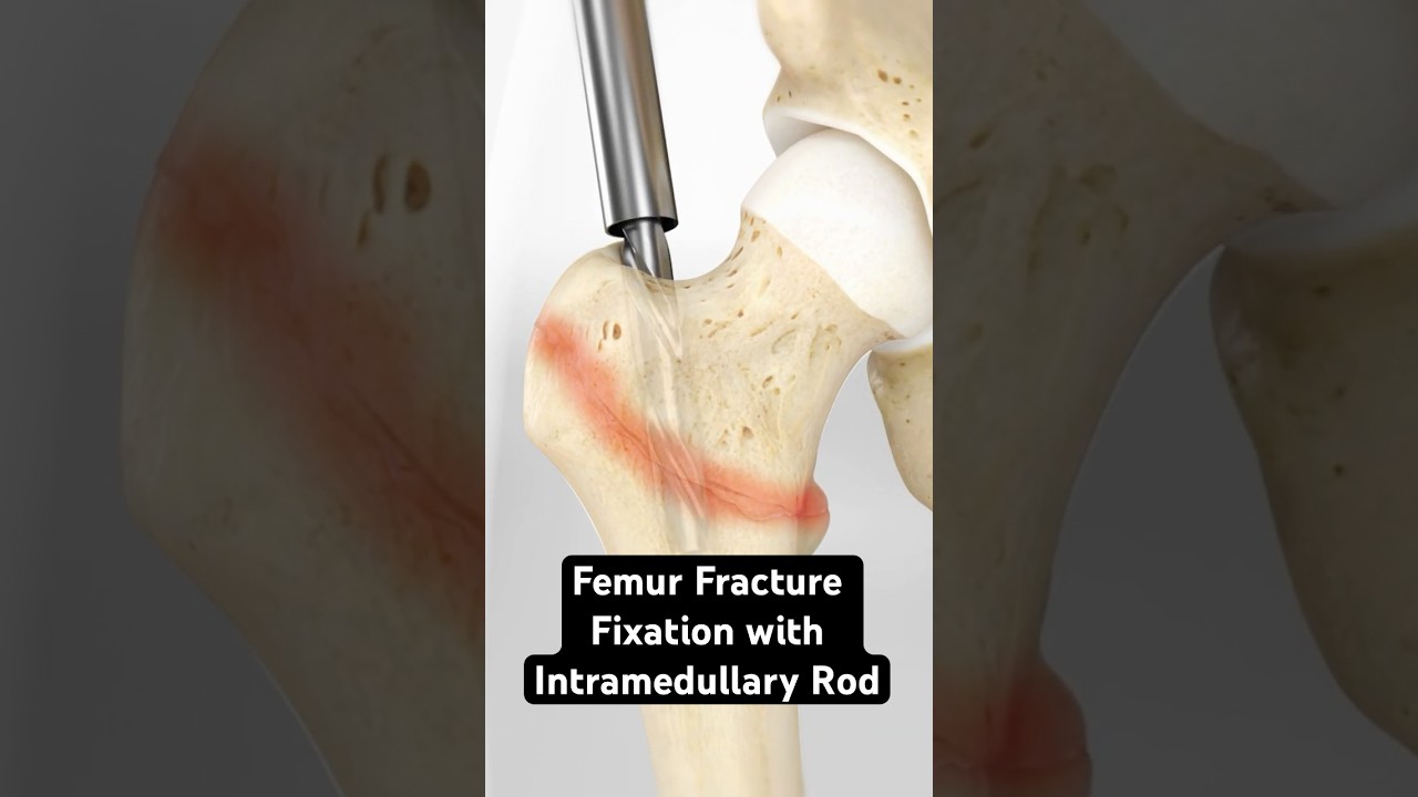 Femur Fracture Fixation with Intramedullary Rod (3D Animation)