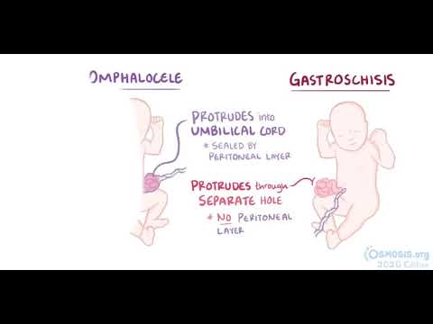 Omphalocele