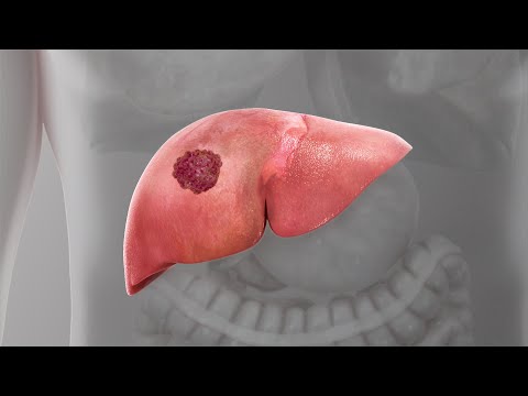 What Is Liver Cancer
