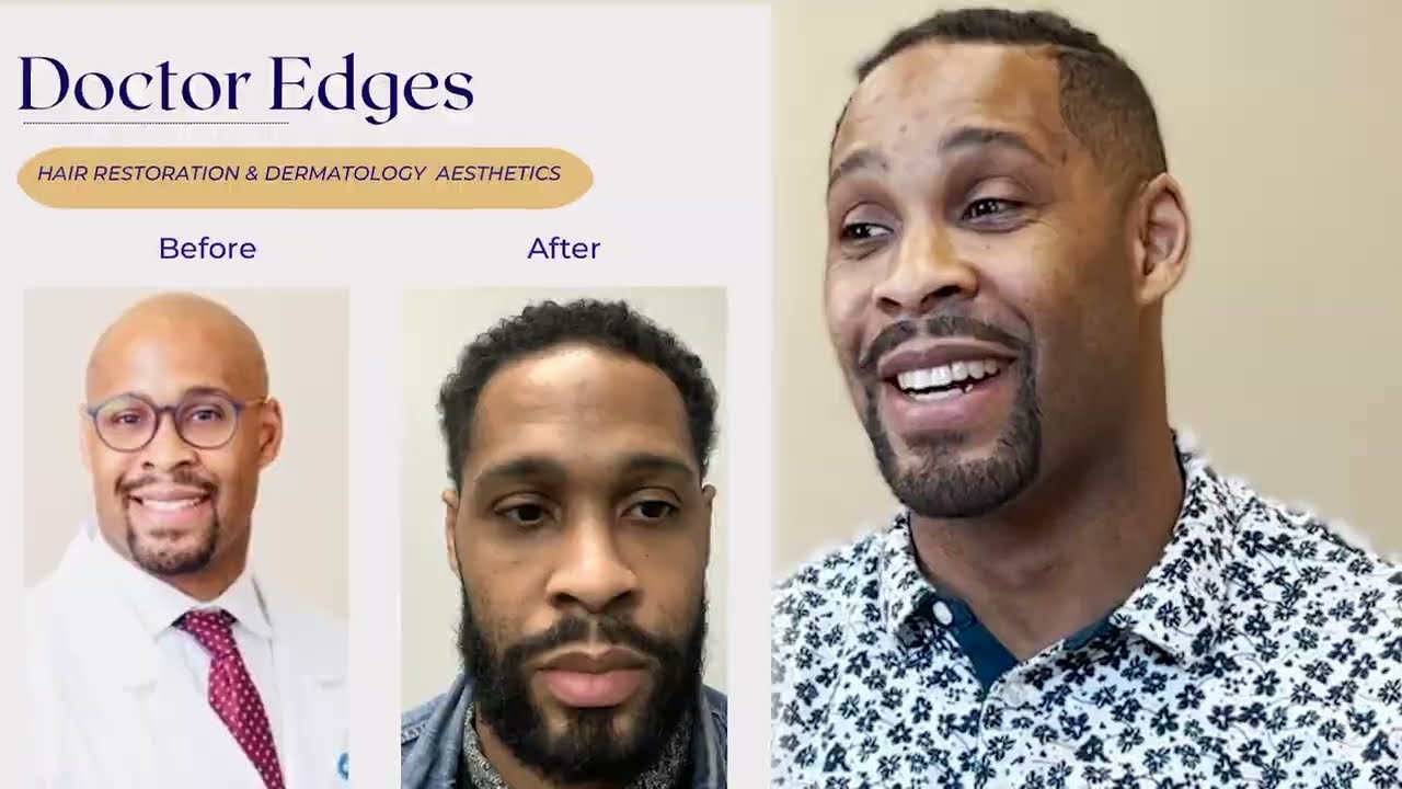 A Bald Head Doctor reacts to his Full Beard: The Biggest Hair & Beard Transformation
