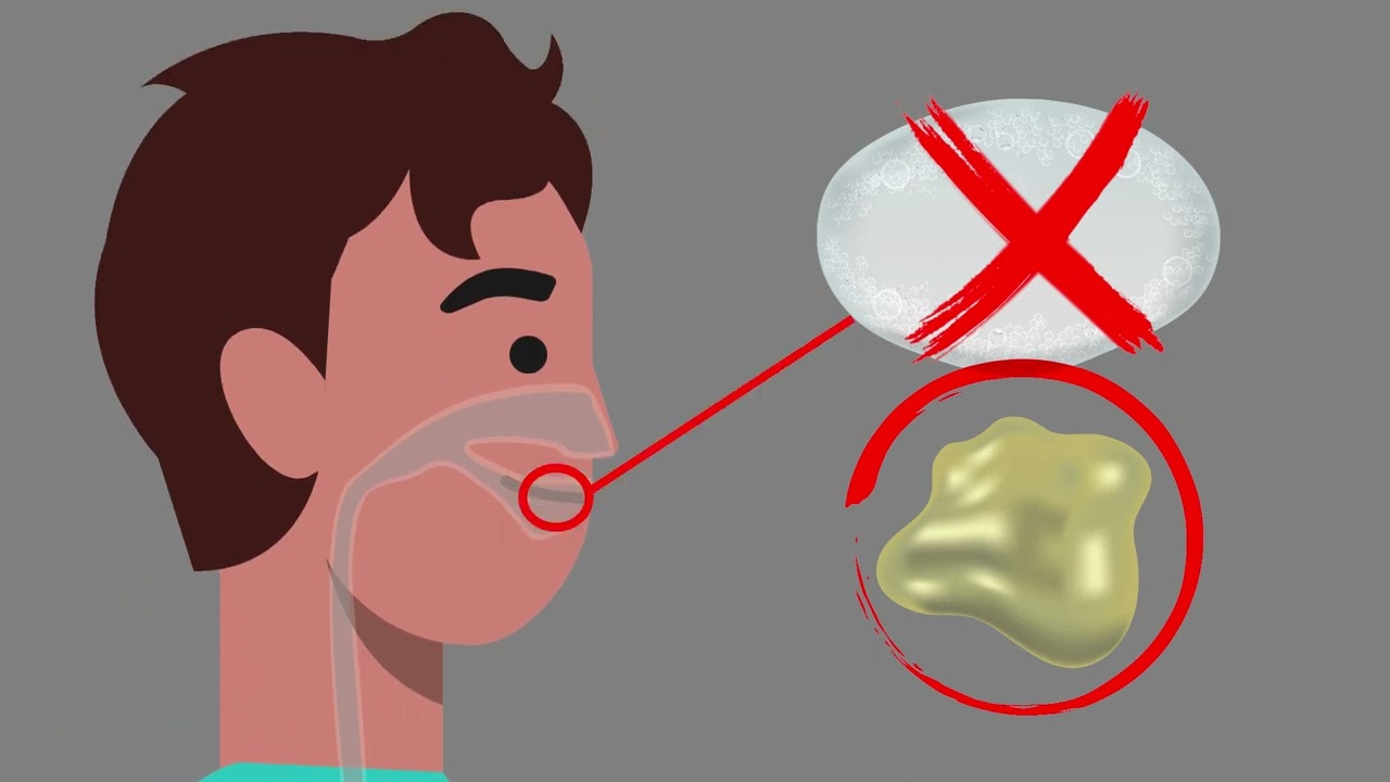 Induced Sputum Collection -  English Version