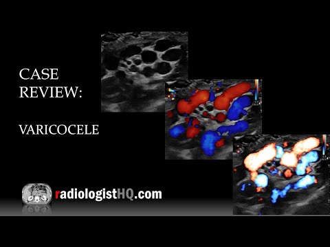 Ultrasound of Varicocele