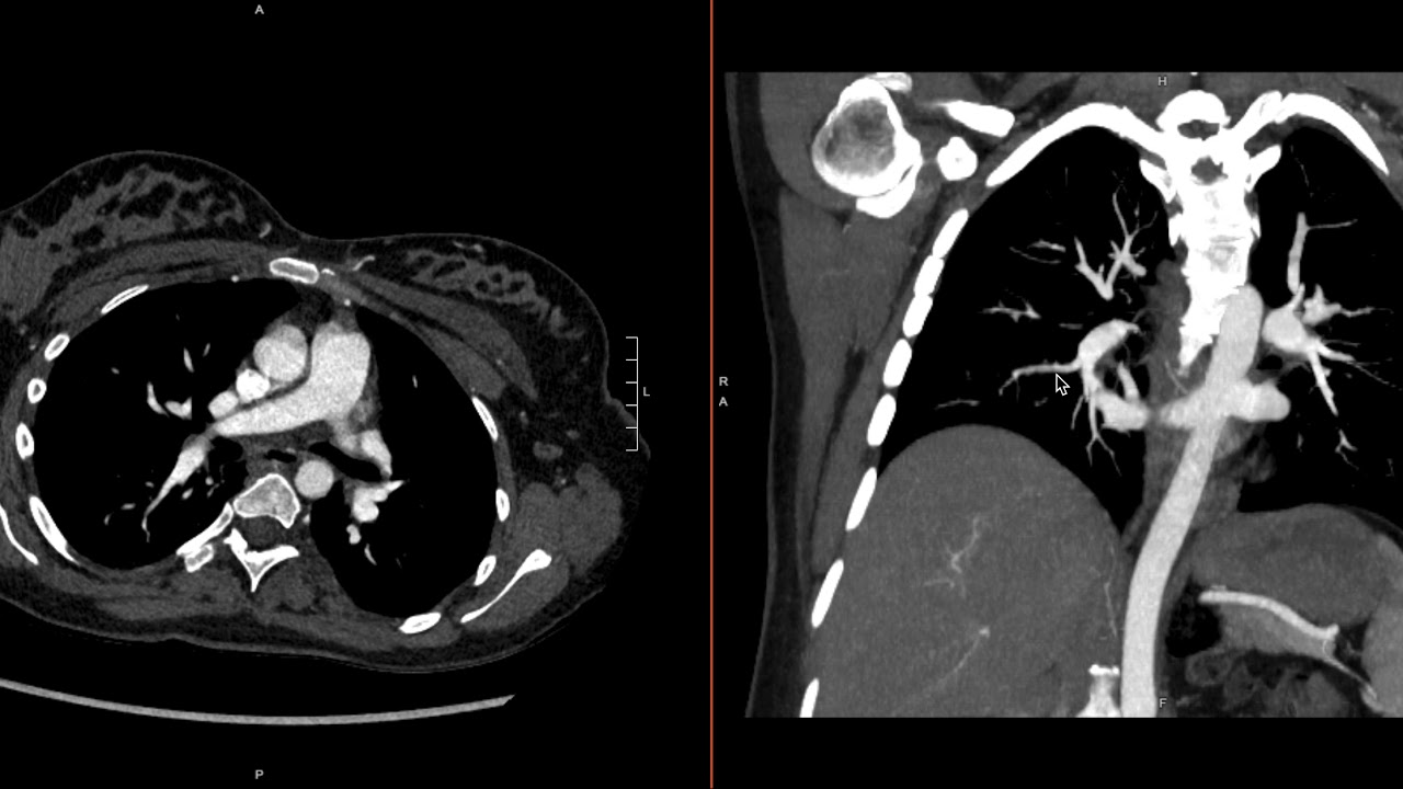 Tracing Pulmonary Arteries Systematically