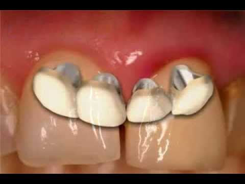 What is the Suclus - Gingiva
