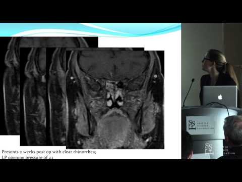 CSF Rhinorrhea Evaluation and Management - Amy Anstead, MD