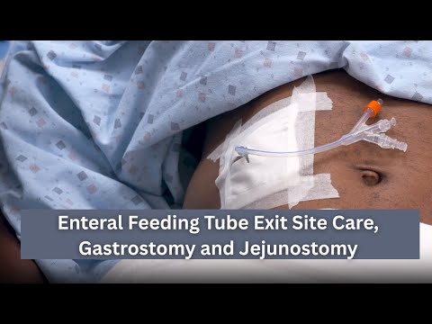 Enteral Feeding Tube Exit Site Care, Gastrostomy and Jejunostomy