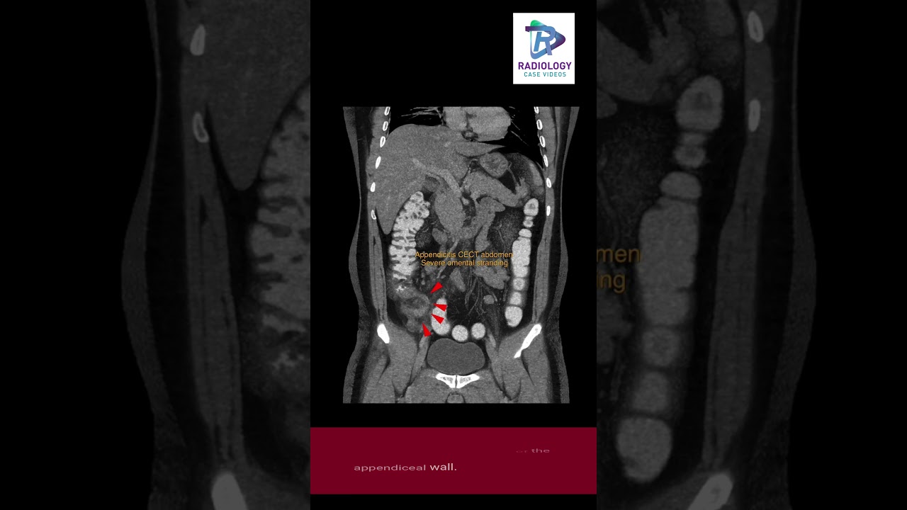 Iliac Fossa