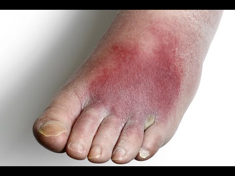CPT code for Incision and drainage of abscess Complicated - simplify medical coding