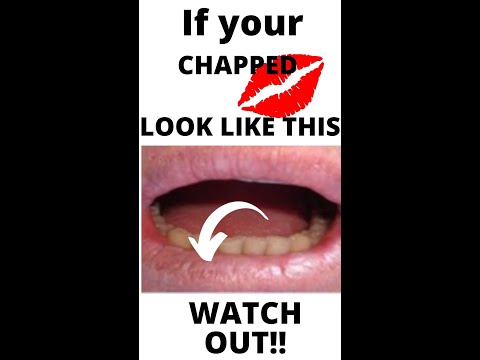 If your chapped lips looks like this watch out!