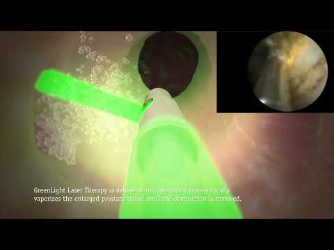 GreenLight for BPH Procedure Animation
