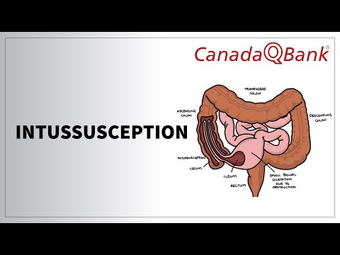 Intussusception