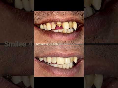 From a HESITANT smile to a BLOCKBUSTER Smile..#dental #smile #cosmeticdentistry #aesthetic #teeth