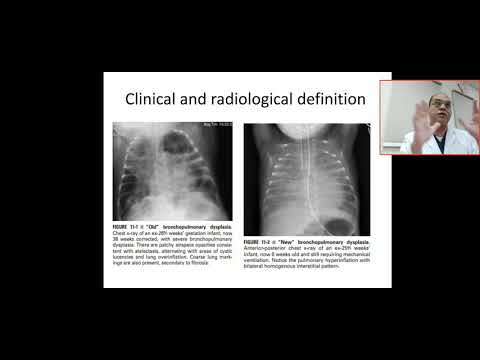Bronchopulmonary dysplasia definition, chronic lung disease