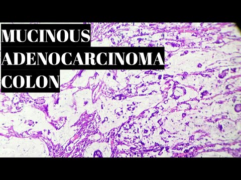 Mucinous Adenocarcinoma Colon Histopathology