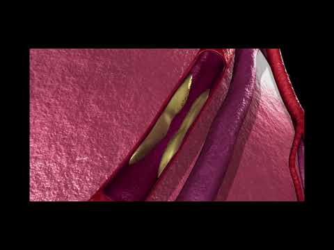 Coronary Angioplasty Procedure EXPLAINED! Medical Coding Reference!