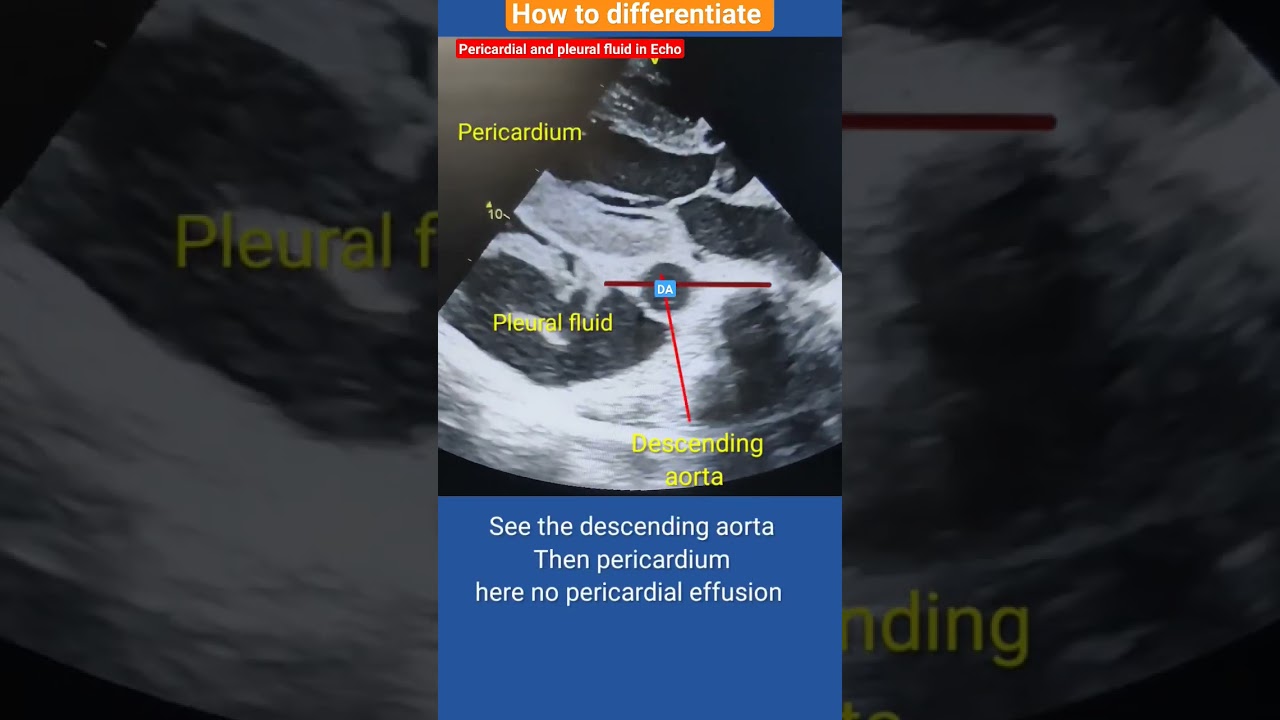 How to identify fluid in echo ( pericardial or pleural) ? #echo #shorts
