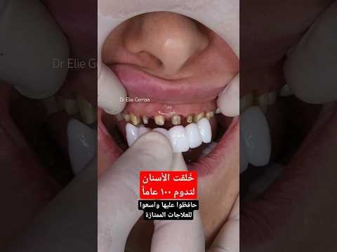 اسنان صحيّة ل ١٠٠ عام | Zirconia Crowns