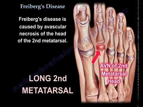 Freiberg's Disease - Everything You Need To Know - Dr. Nabil Ebraheim