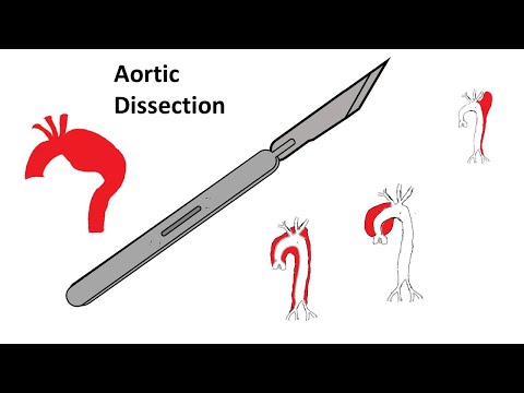 AORTIC DISSECTION : Definition Etiology Pathogenesis Morphology Clinical Complications Treatment ||