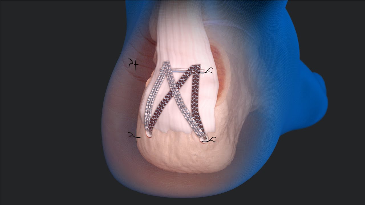 MIS FiberTak® Achilles SpeedBridge™ Repair System Animation