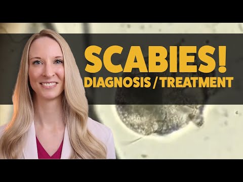 SCABIES: DIAGNOSIS, TREATMENT, CAUTIONARY TIPS from a Dermatologist