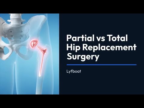 Partial Hip Replacement vs. Total Hip Replacement | Total/Partial Hip Replacement Surgery Explained