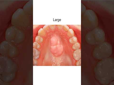 Roof of Mouth Growth (Torus Palatinus) #shorts @fauquierent