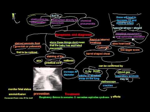Respiratory Distress in neonates -2- meconium aspiration syndrome