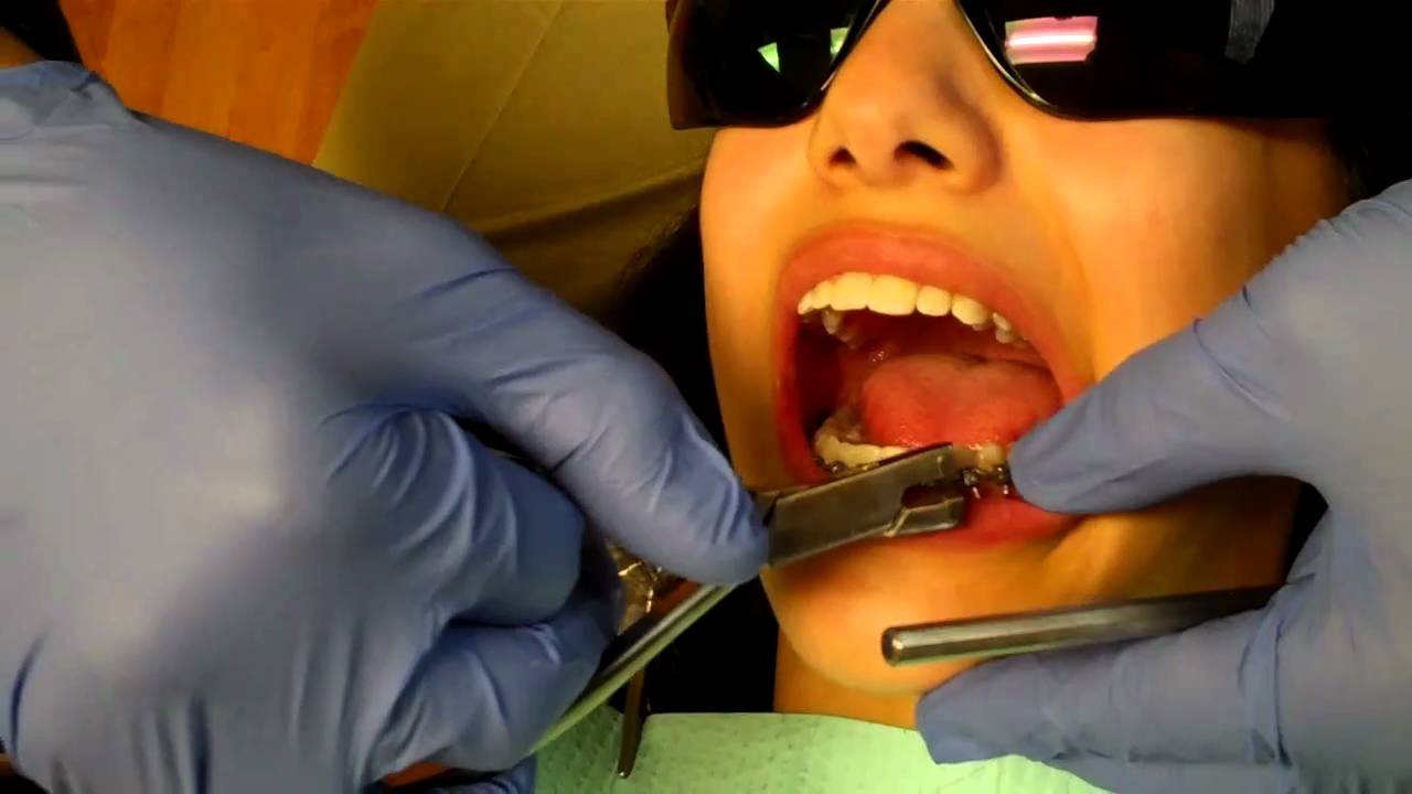 Melissa gets her braces off!