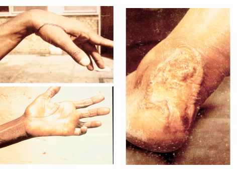 Kusta -- Fred Heinzel, MD