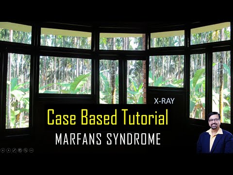 MARFANS SYNDROME - A CASE BASED TUTORIAL ( X-RAY ) .