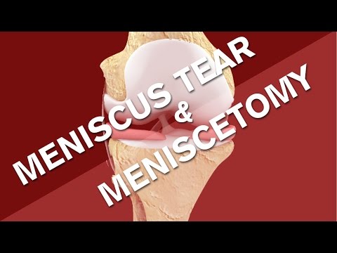What is a meniscus tear?