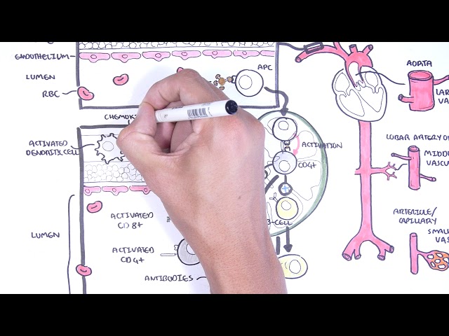 Caplan Syndrome - Armando Hasudungan