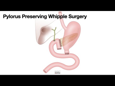 HCC 1475-10f-Surgical Anatomy-Pylorus Preserving Whipple