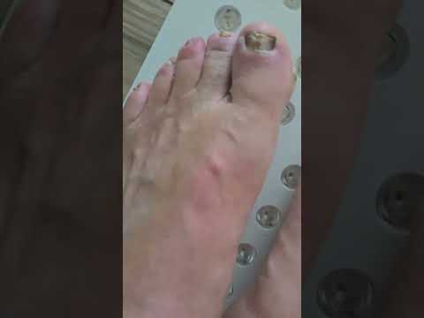 Might lose a toenail