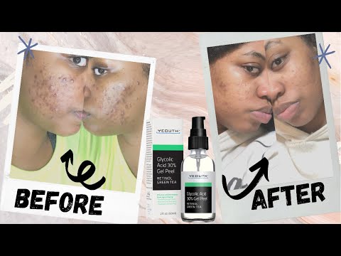 BEST CHEMICAL PEEL FOR ACNE SCARS AT HOME | Before & After Pictures | Yeouth Glycolic Acid Gel Peel