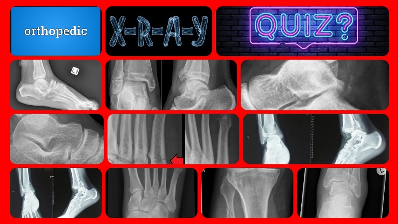 orthopedics( lower limb) x-ray clinical cases quiz part # 2 | case 11-20 | x-ray made easy | x-ray❤️