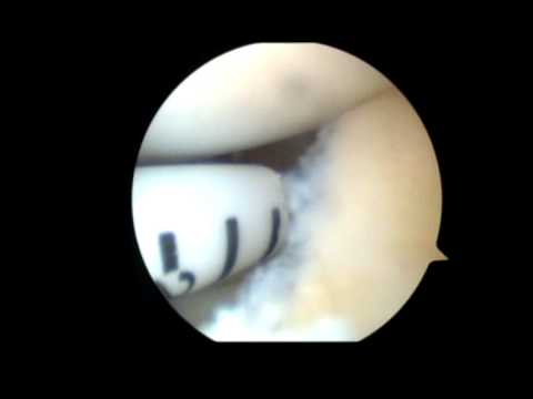 Discoid meniscus tear and repair Dr.Bancha Chernchujit.wmv