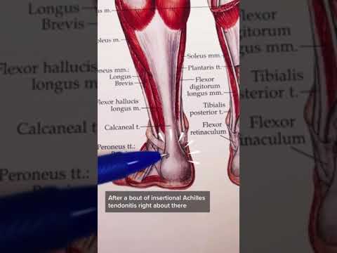 Insertional Achilles Tendonitis