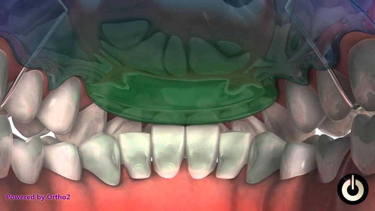 Bite Plate for Deep Bite