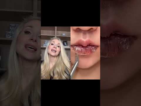 Lip mask or exfoliative cheilitis? #shorts