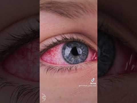 5 señales que pueden indicar alergia ocular 👈🏻😭
